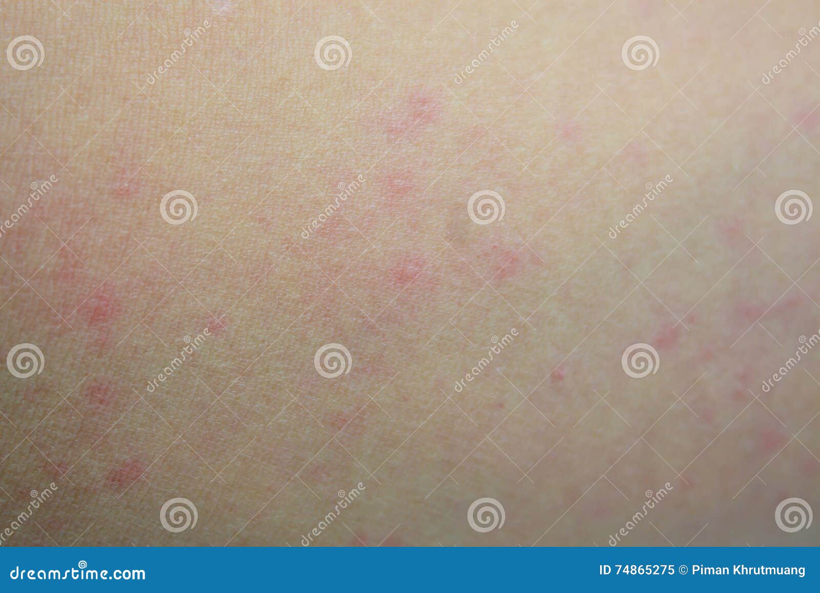 Ill Allergic Rash Dermatitis Eczema Skin Stock Image - Image of ...