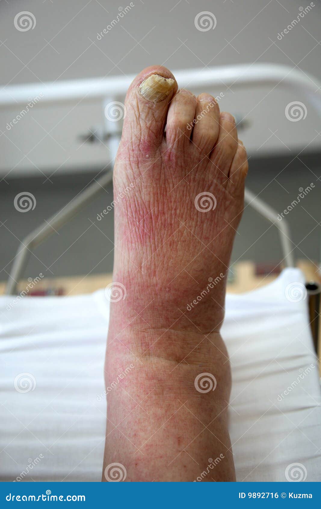 Illness foot stock photo. Image of sole, health, surgery - 9892716