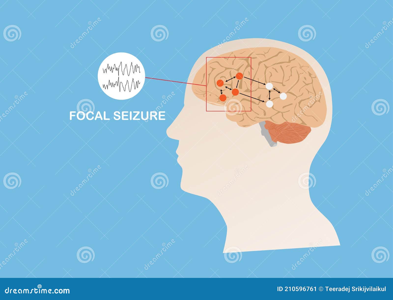 Illustration of Abnormal Electrical Activity Causing Focal Seizure ...