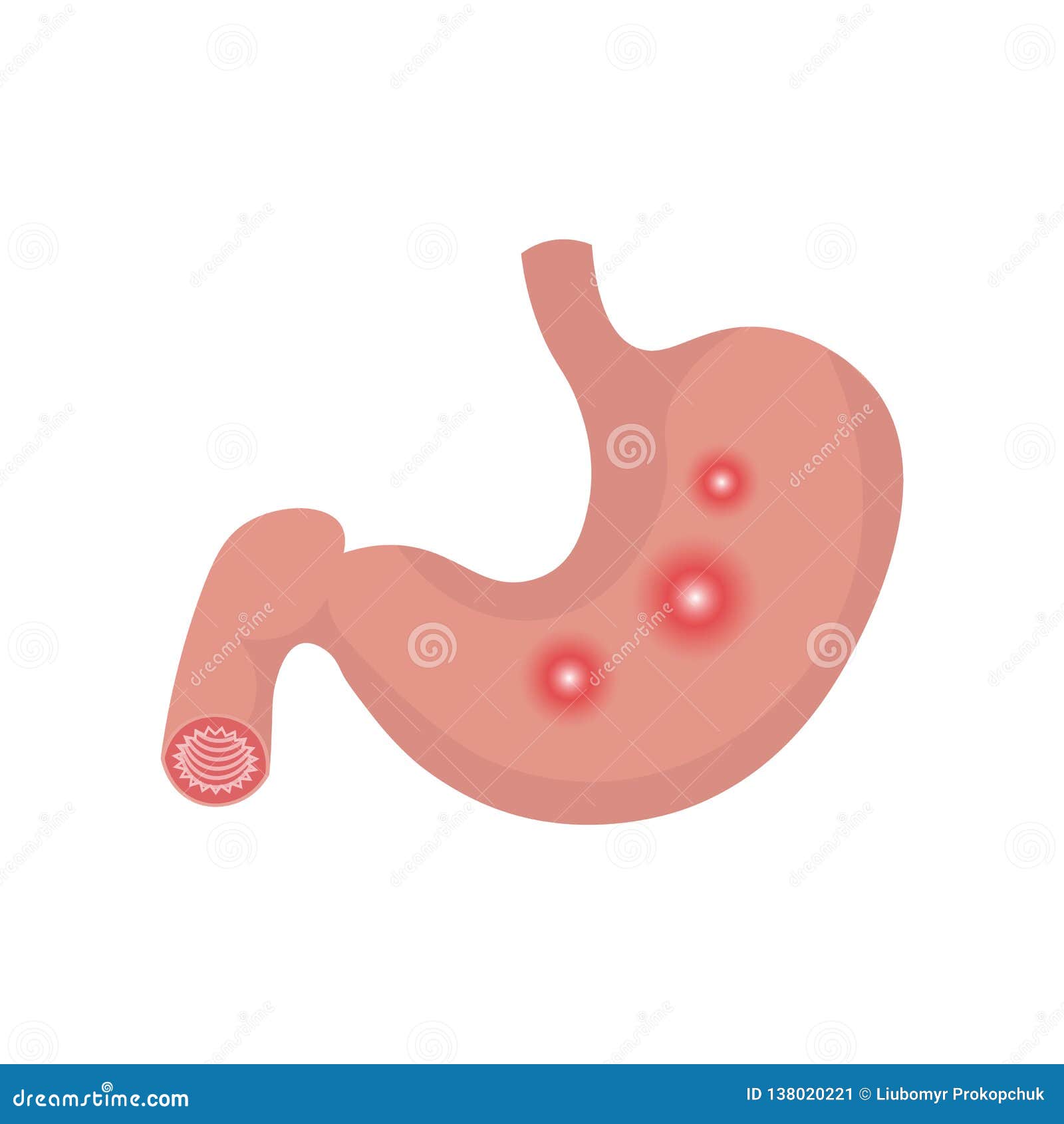 Illustration from Acid Reflux or Heartburn Stock Vector - Illustration ...