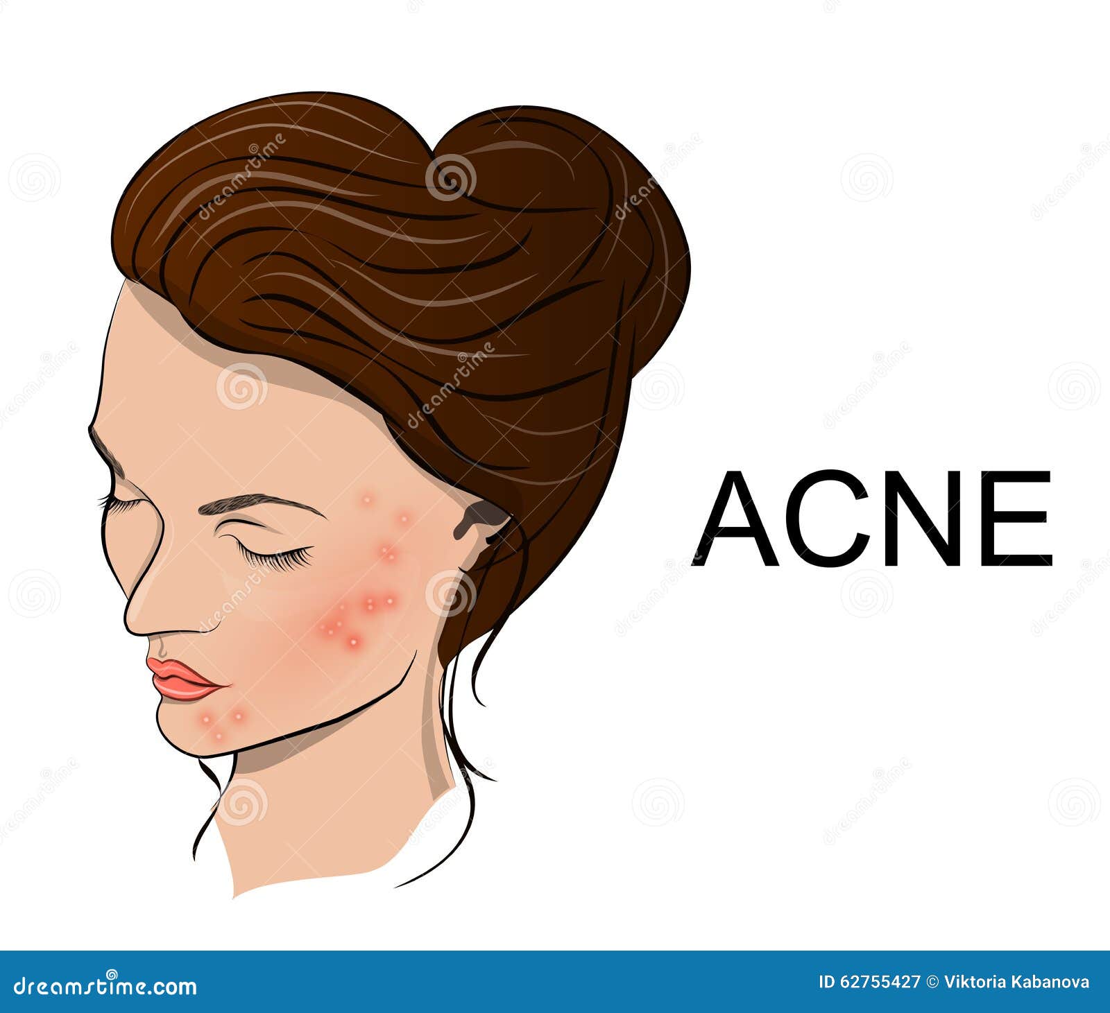 Illustration of acne stock vector. Illustration of cosmetic - 62755427