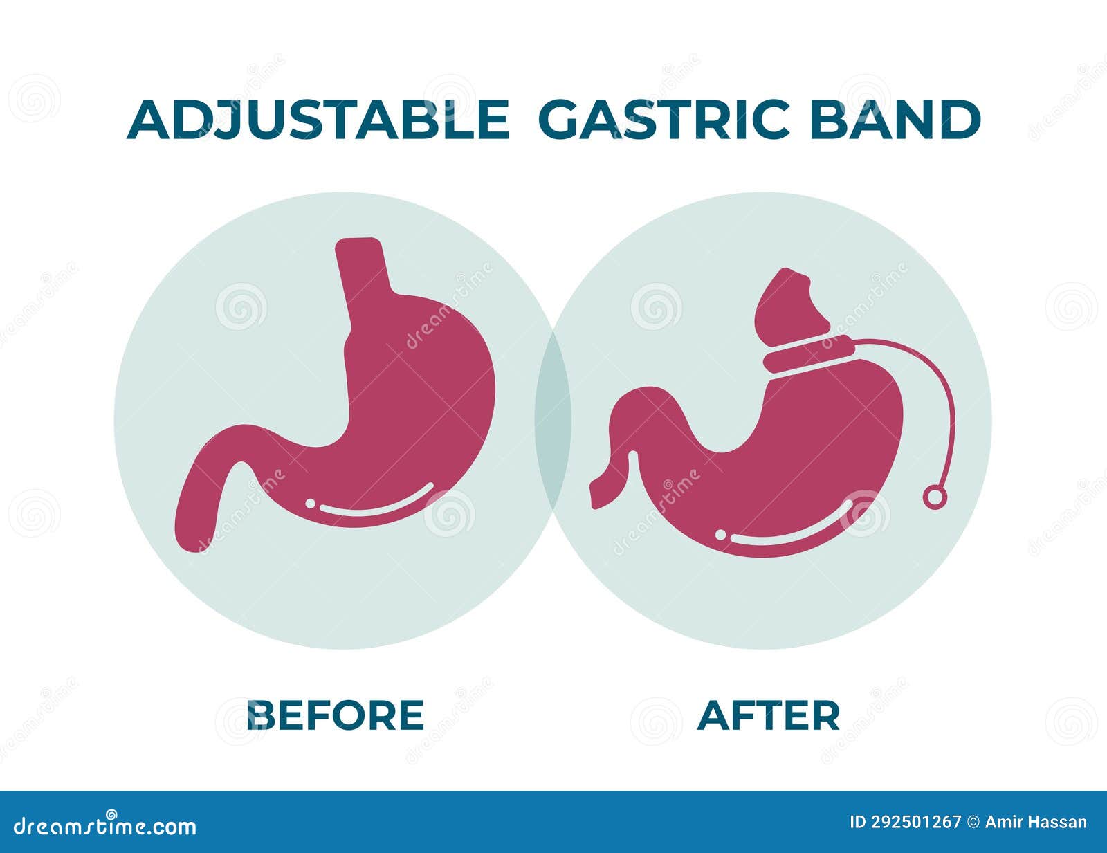 Illustration of Adjustable Gastric Band Devise Weight Loss Surgery ... Illustration of Adjustable Gastric Band Devise Weight Loss Surgery ...