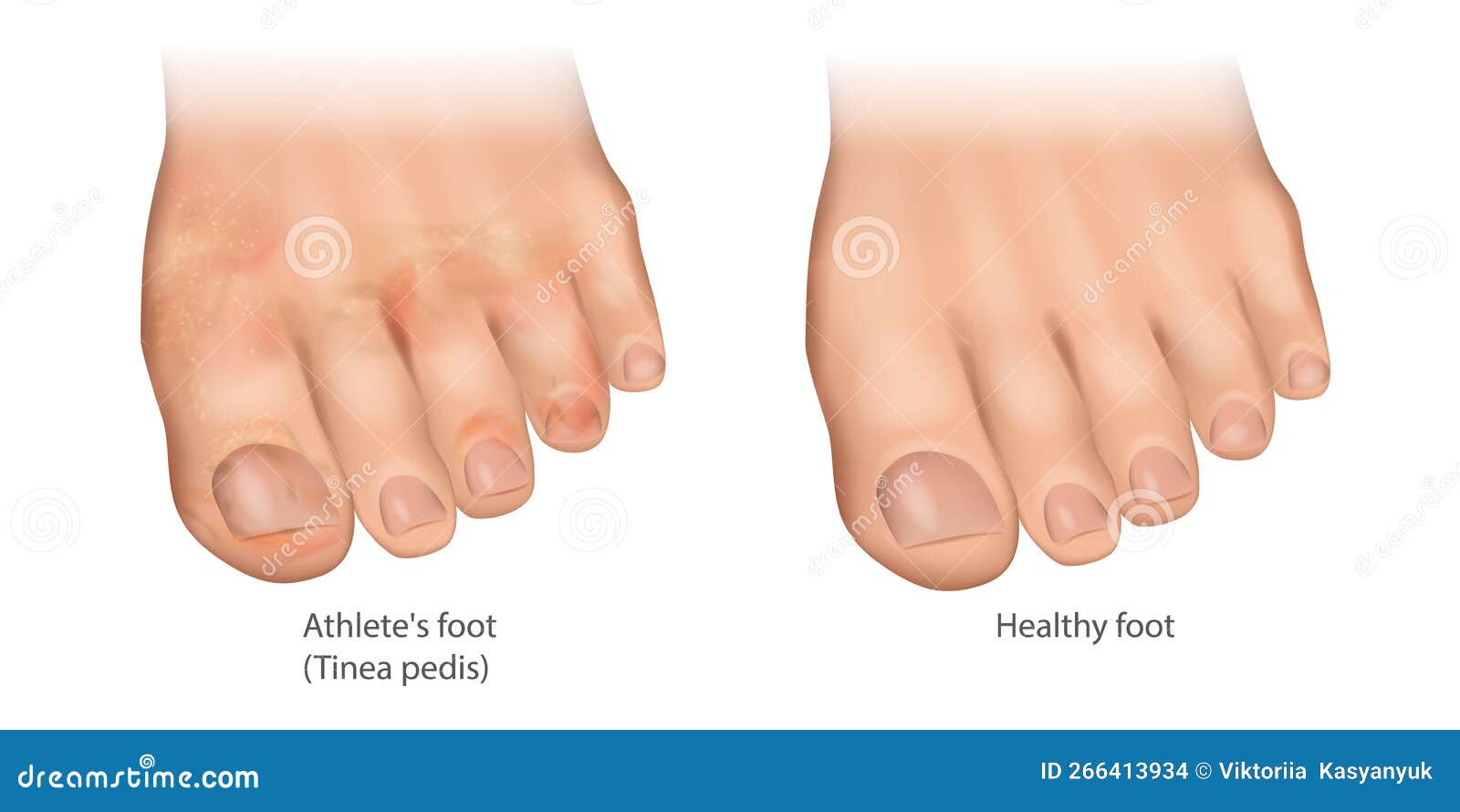 Illustration of the Athlete S Foot and Healthy Foot. Tinea Pedis or ... Illustration of the Athlete S Foot and Healthy Foot. Tinea Pedis or ...