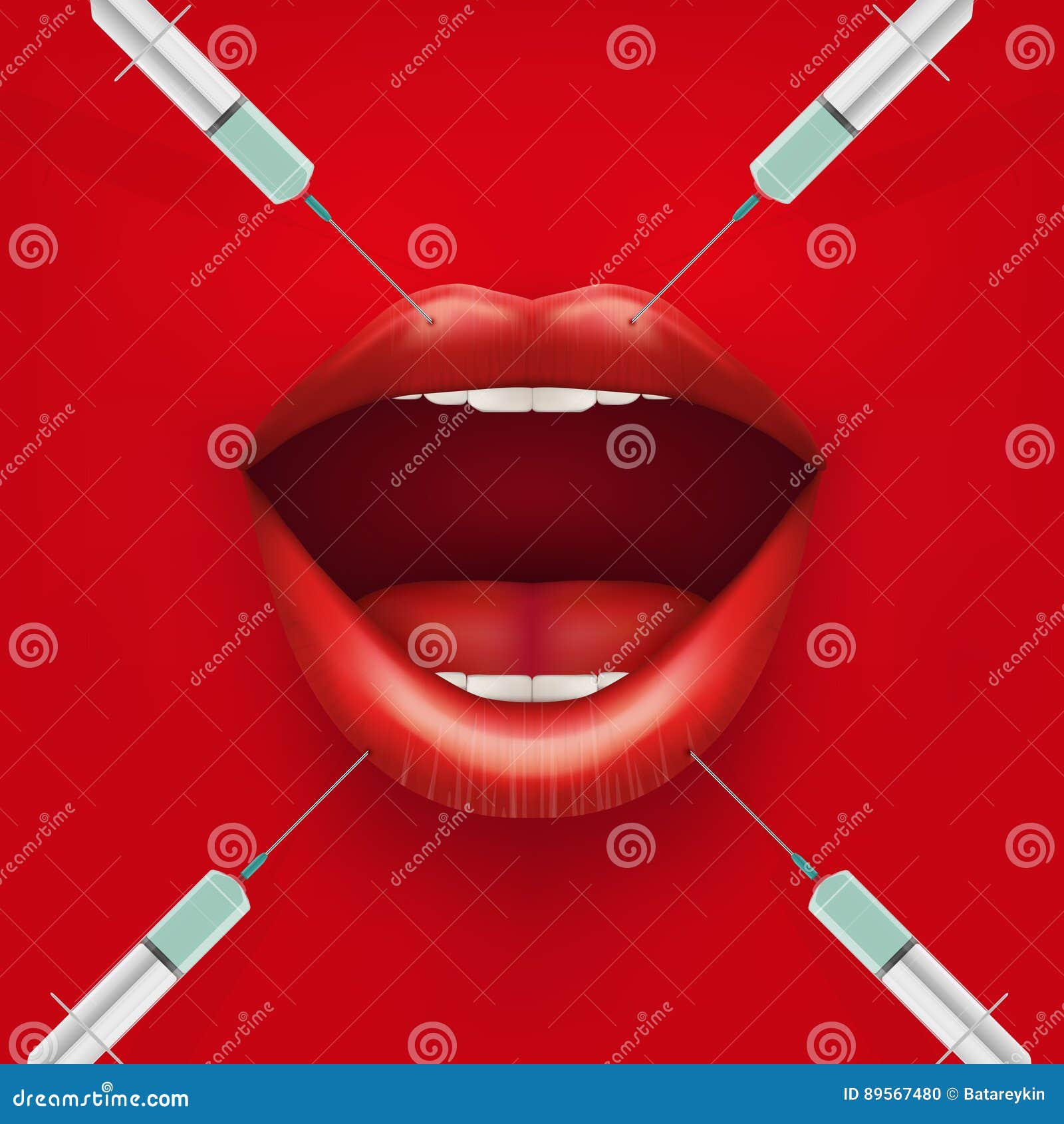 Illustration of a Botox Injection. Stock Illustration - Illustration of ...