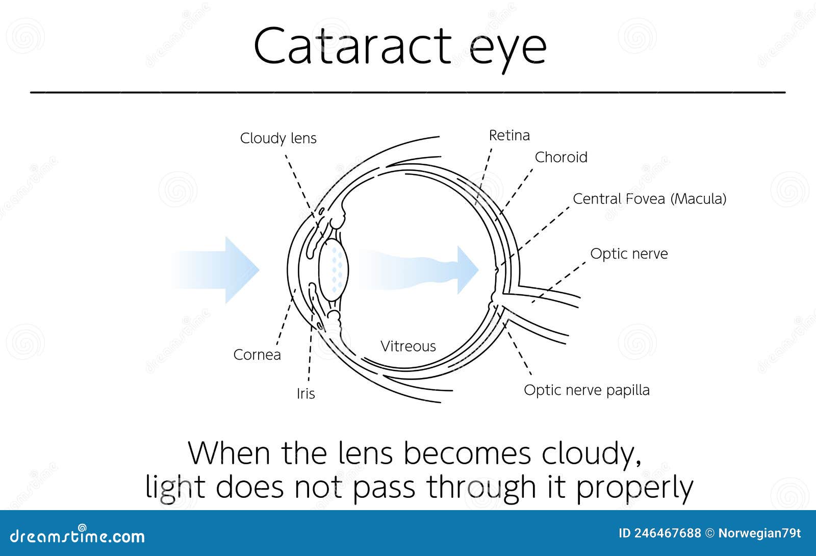 Illustration, Cataract Eye, Medical Illustrations Stock Illustration ...
