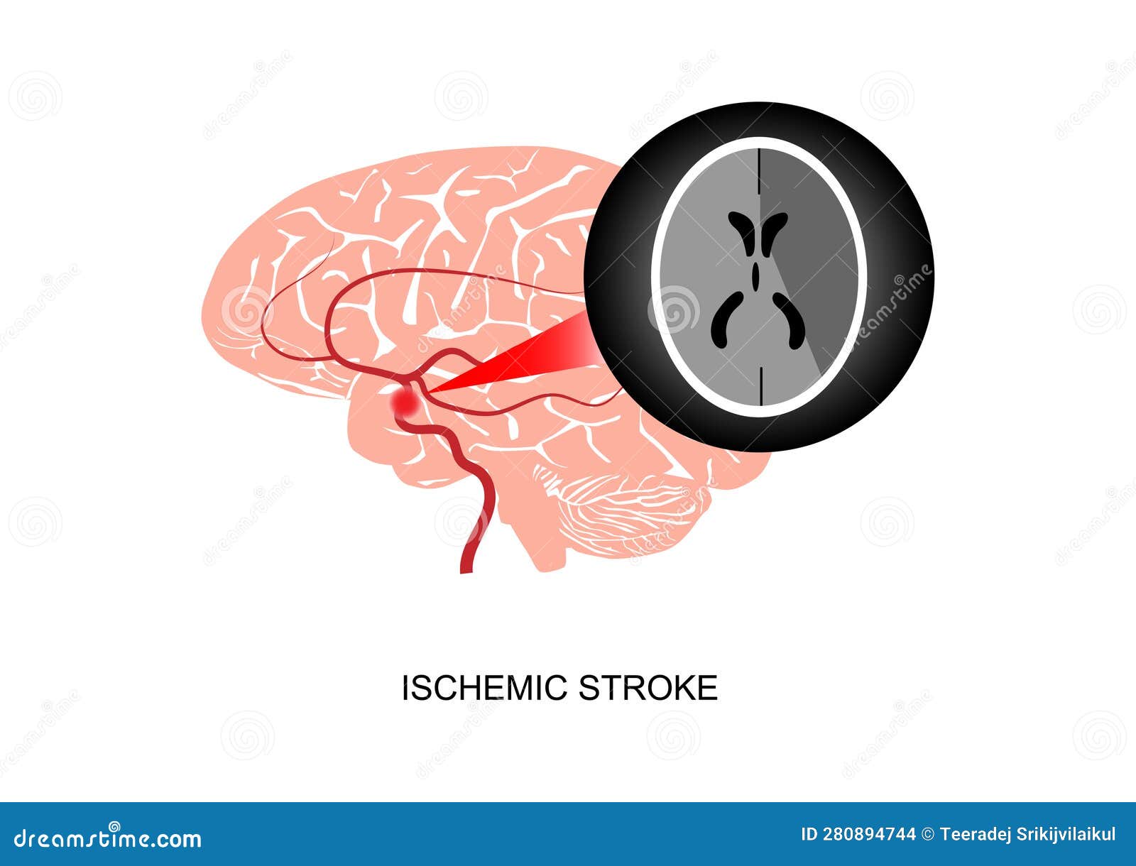 Illustration Of Cerebral Ischemic Stroke And Imaging Royalty-Free Stock ...