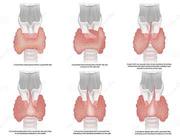 Illustration of the Classification of the Thyroid Gland Shapes. the ...