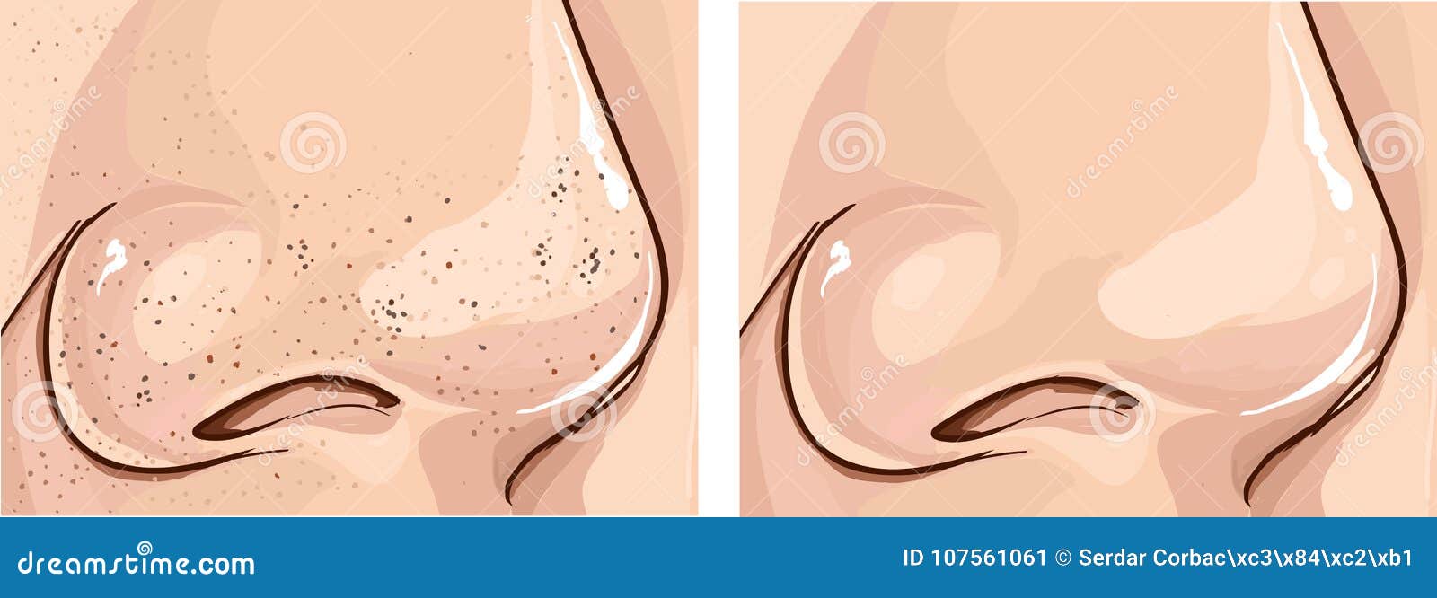 Illustration of Clogged Pores and Clean Pores on Nose Stock Vector ... Illustration of Clogged Pores and Clean Pores on Nose Stock Vector ...