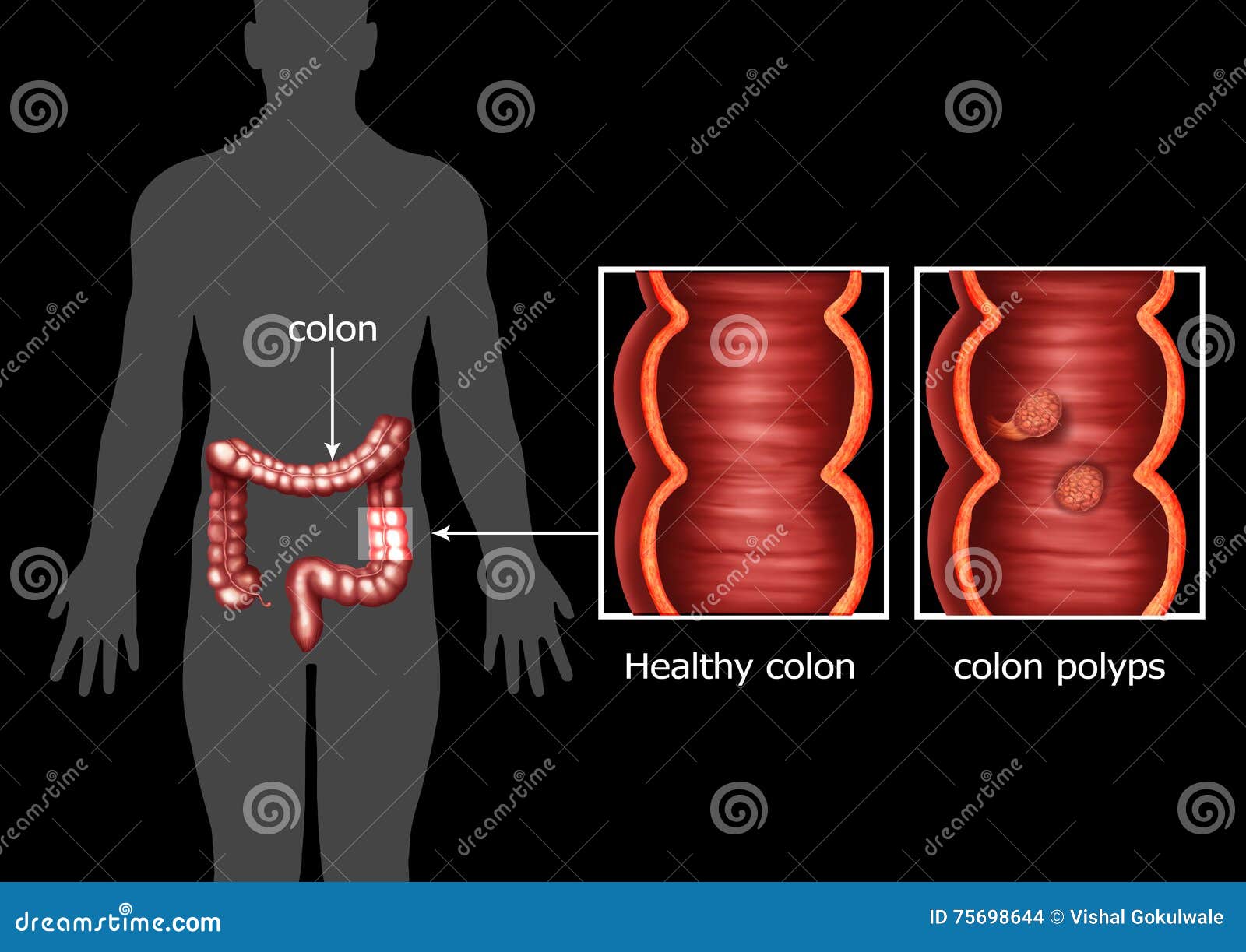 Illustration of the colon stock illustration. Illustration of digestion ...