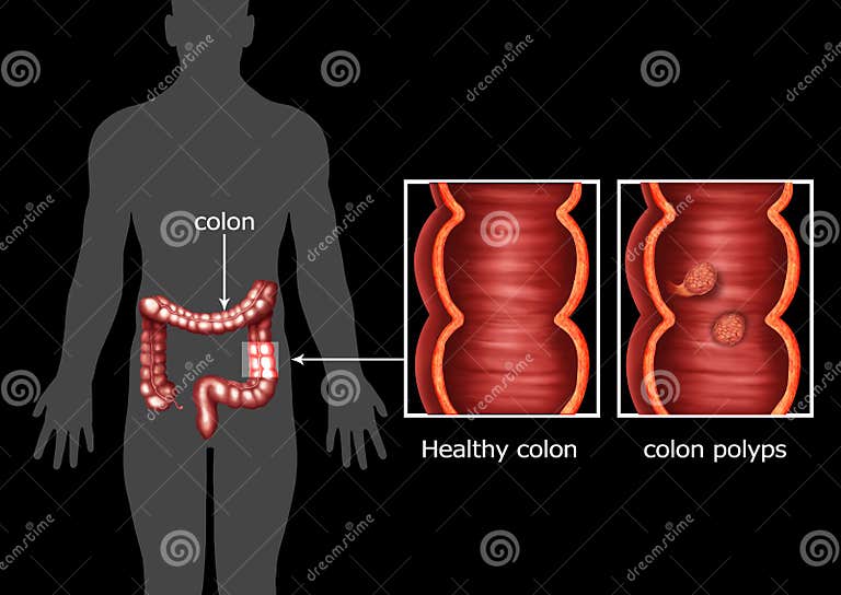 Illustration of the colon stock illustration. Illustration of digestion ...