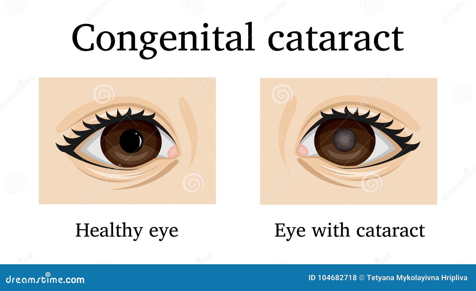 Congenital Cataracts In Adults