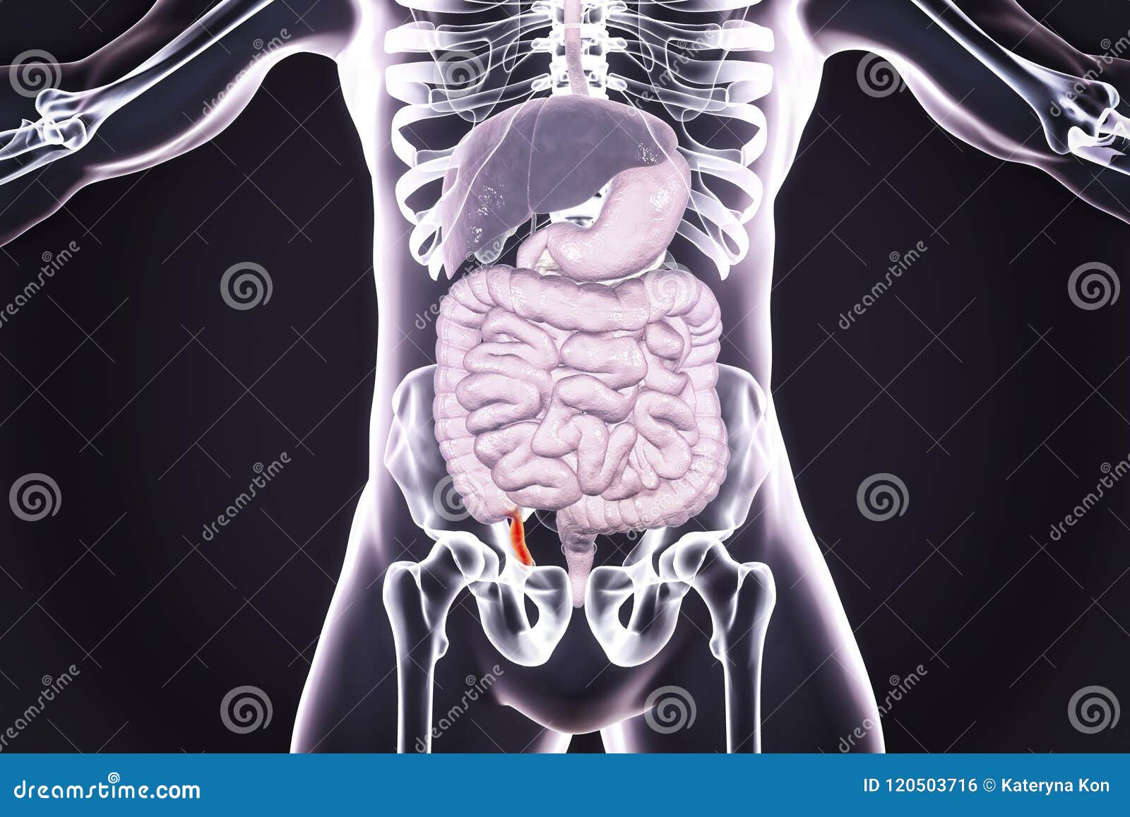 Illustration D'appendicite Aiguë Illustration Stock - Illustration du ...