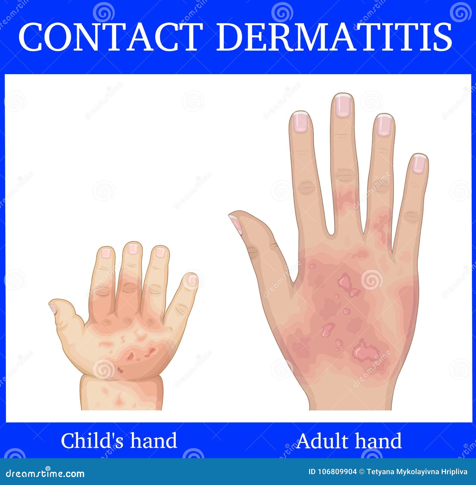 Illustration De Dermite De Contact Illustration de Vecteur ...