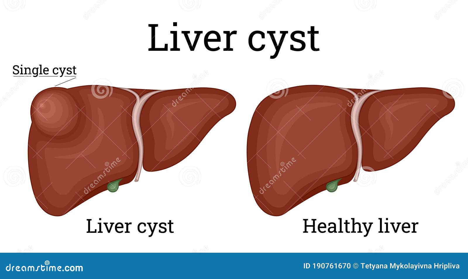 Illustration De Kyste Du Foie Illustration de Vecteur - Illustration du ...
