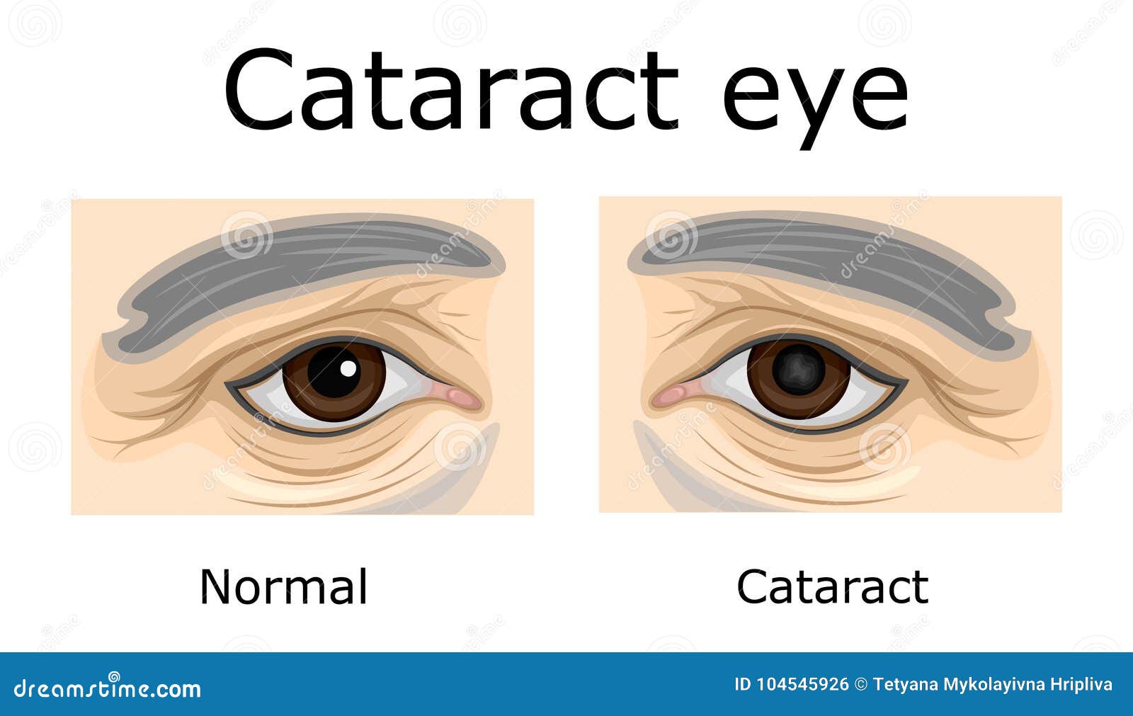 Illustration De L'oeil De Cataracte Illustration de Vecteur ...