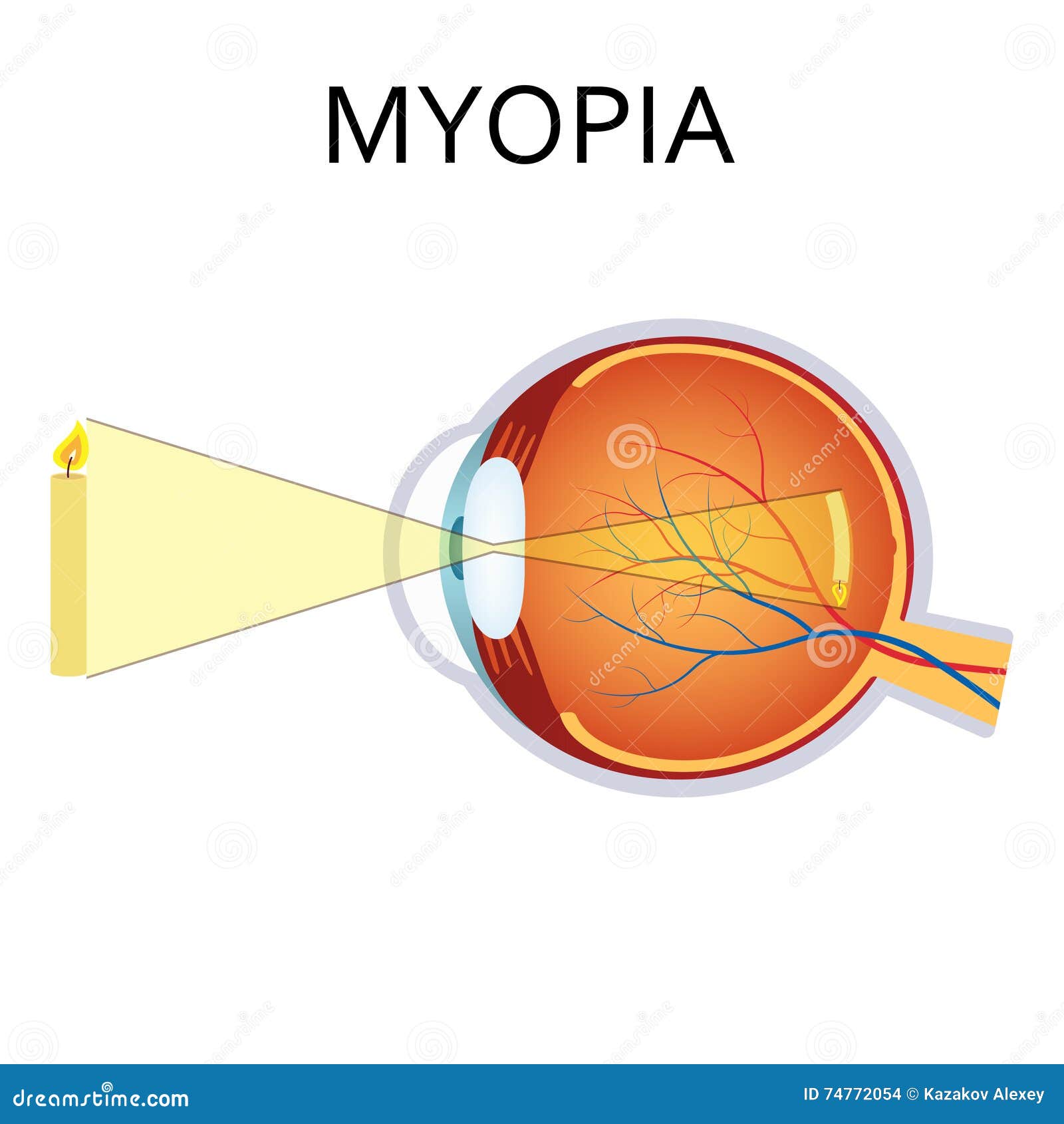 Illustration de la myopie illustration de vecteur. Illustration du ...