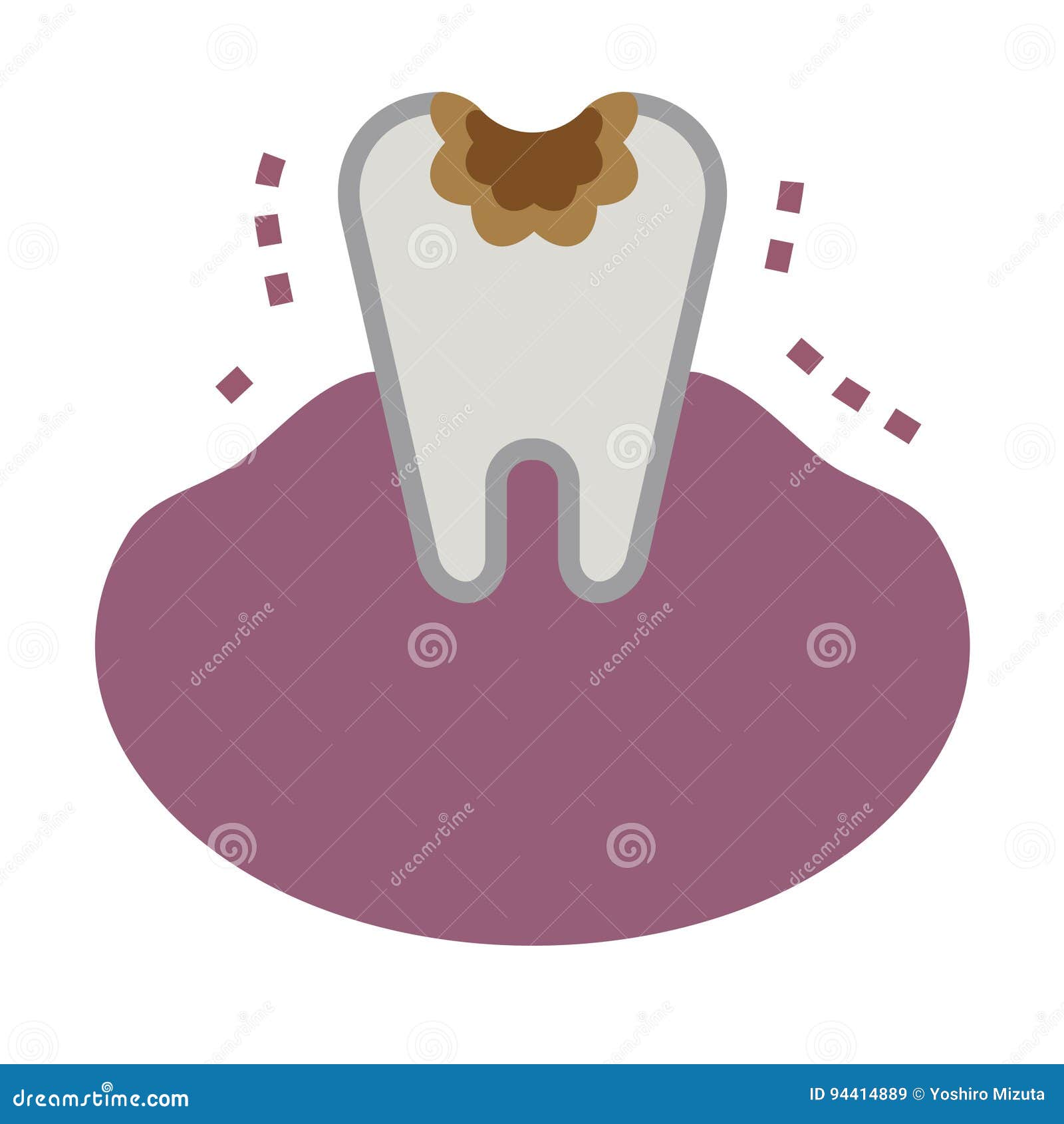 Illustration of a Decayed Tooth Stock Vector - Illustration of ...
