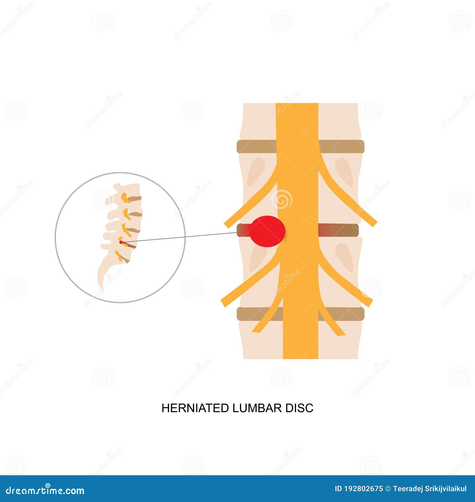 Human Herniated Disk Royalty-Free Illustration | CartoonDealer.com ...