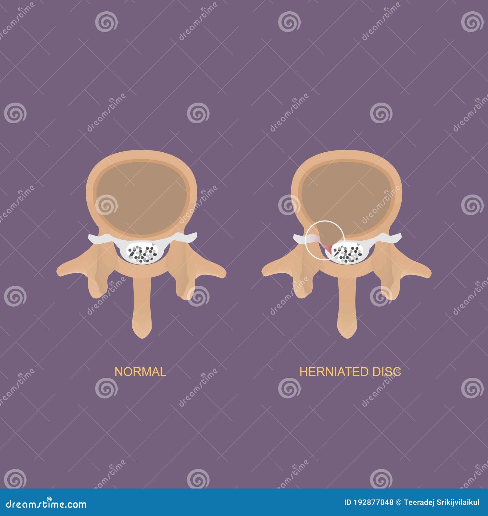 Illustration Demonstration Of Human Herniated Lumbar Disc Stock Vector