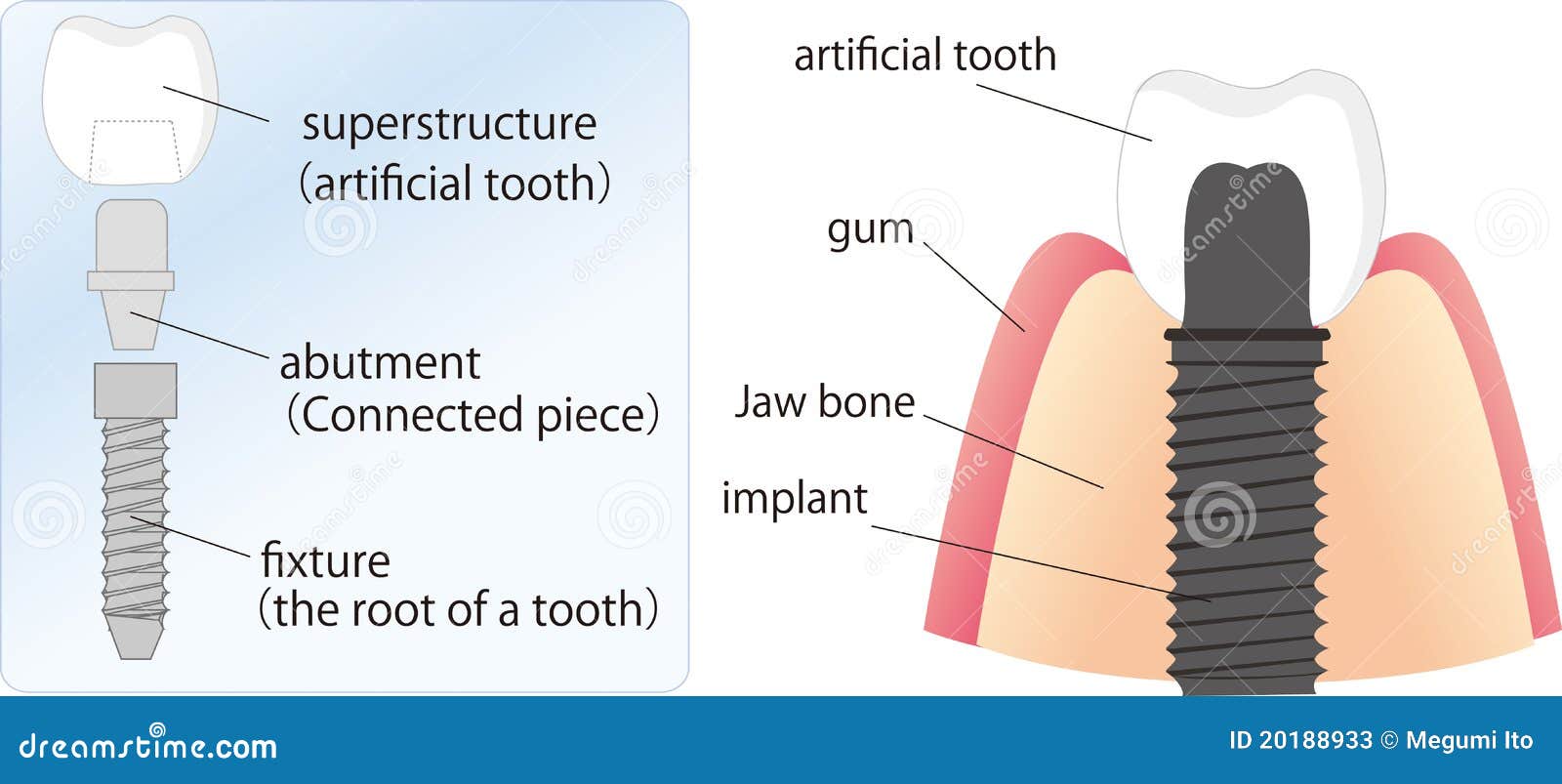 Illustration of Dental Implant Stock Illustration - Illustration of ...