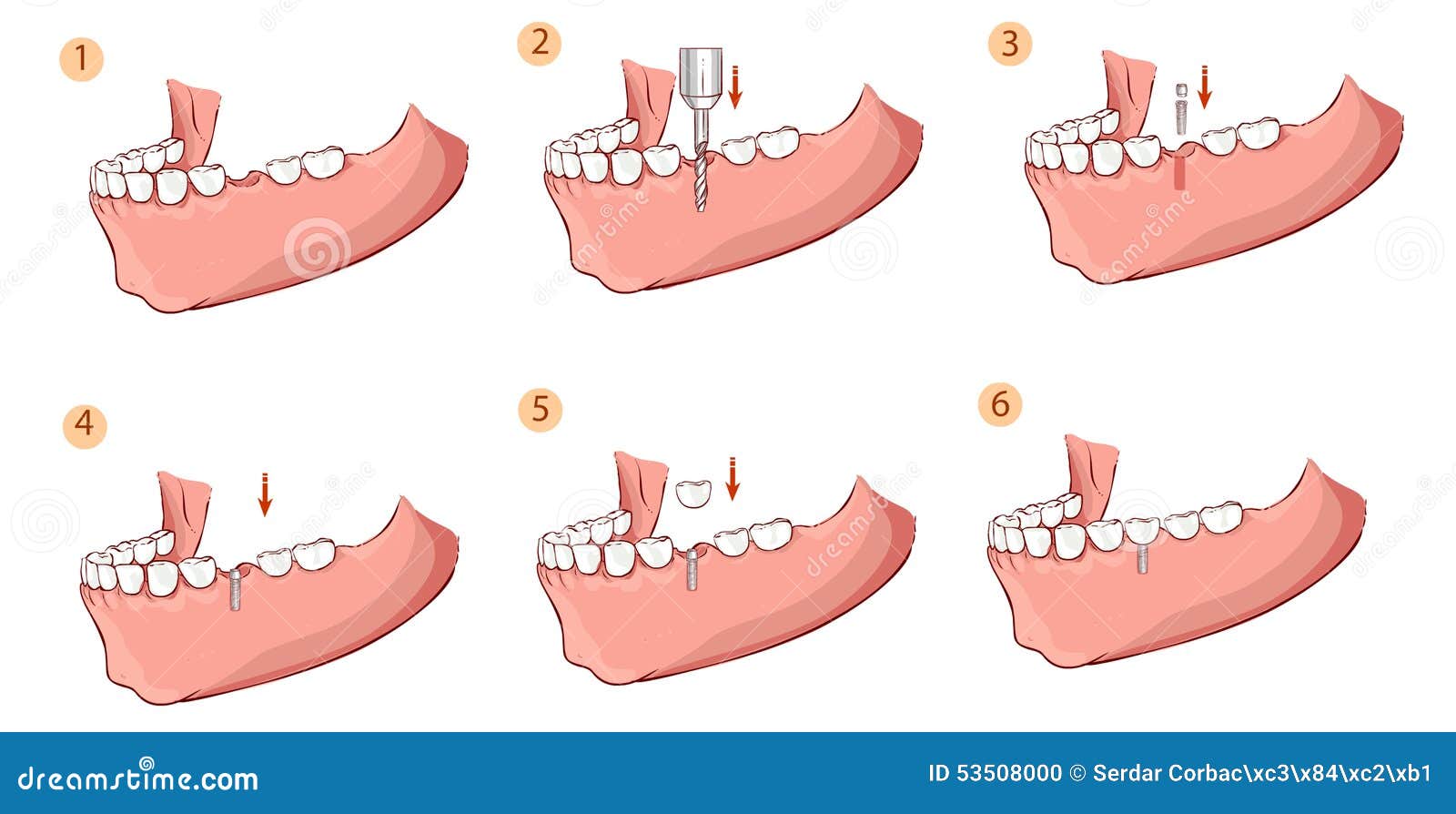 Illustration of a Dental Implant Stock Vector - Illustration of root ...