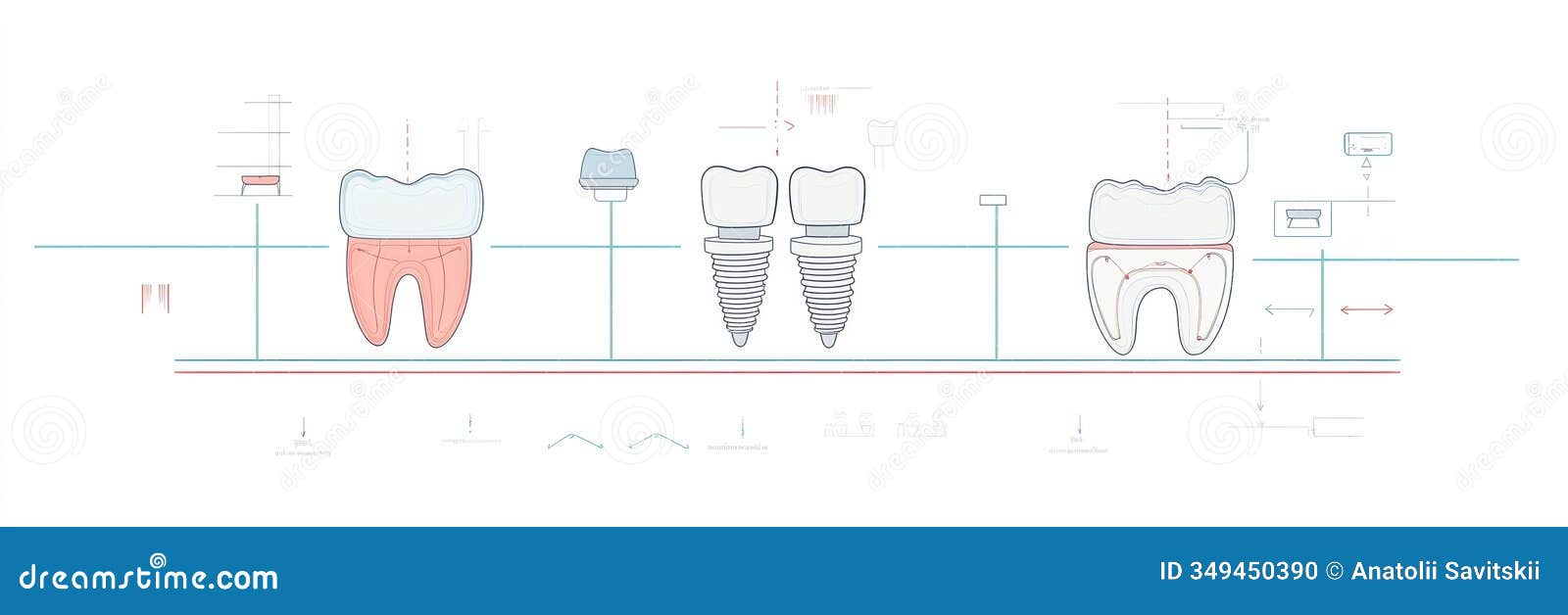 Illustration Depicting the Three Stages of the Dental Implant Process ...