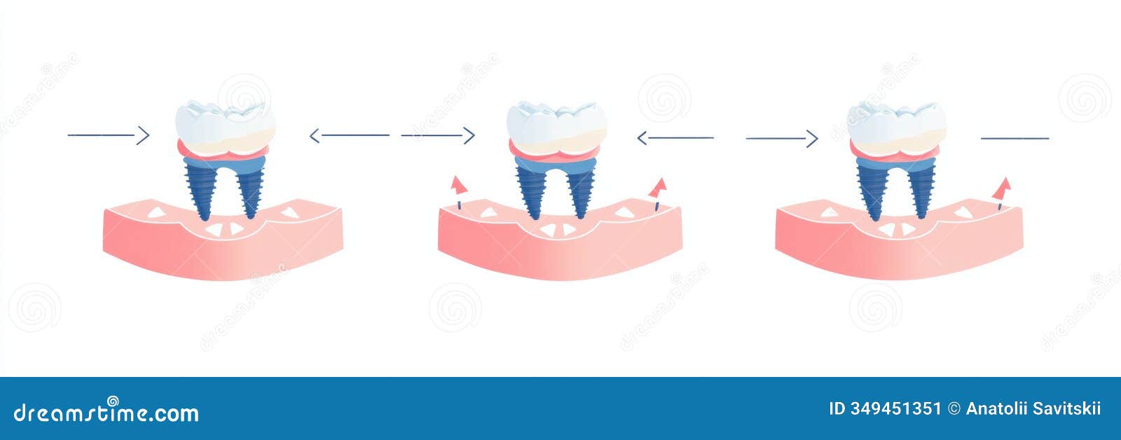 This Illustration Depicts the Three Stages of the Dental Implant ...