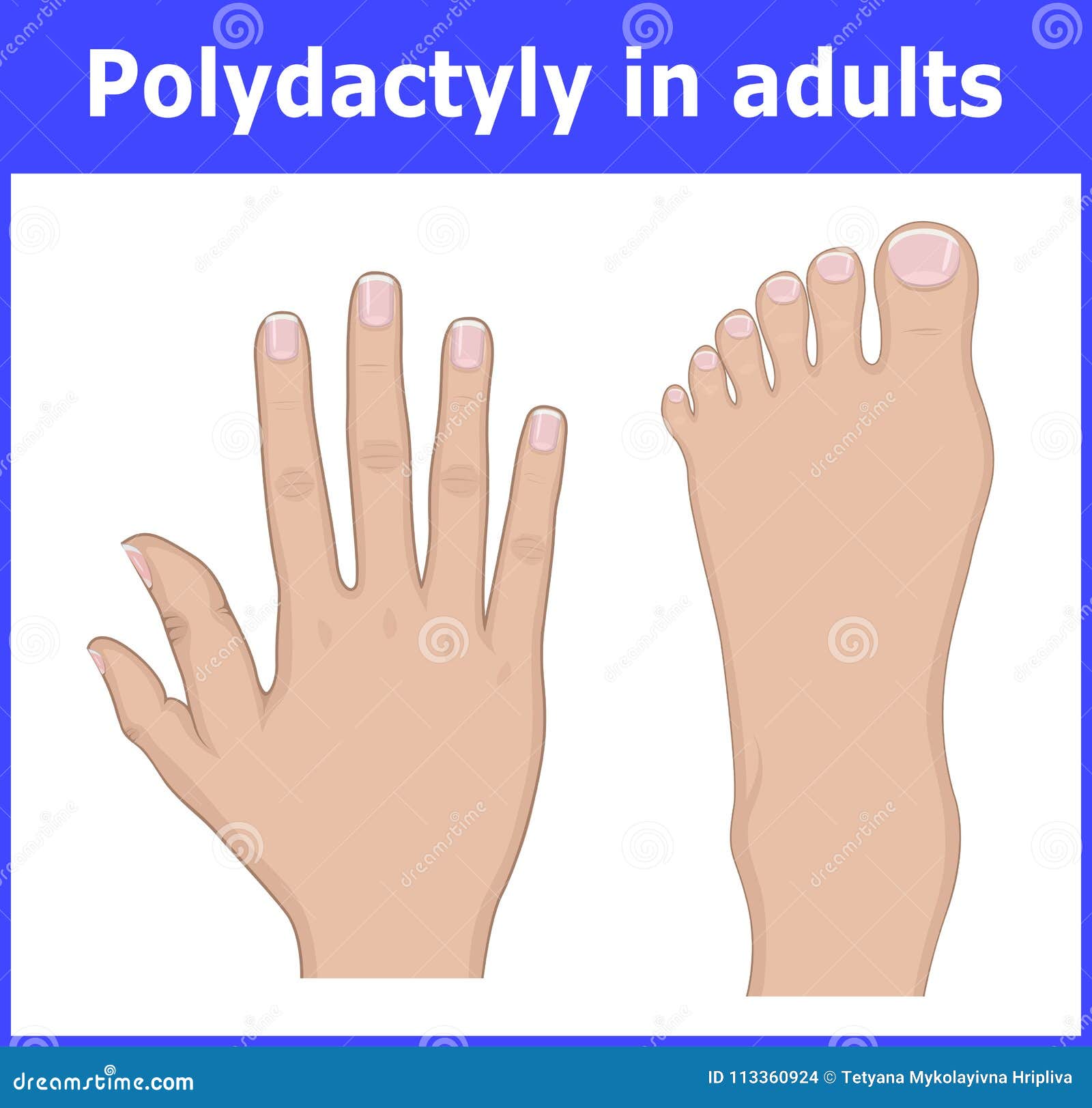 Illustration Der Polydaktylie in Den Erwachsenen Vektor Abbildung ...