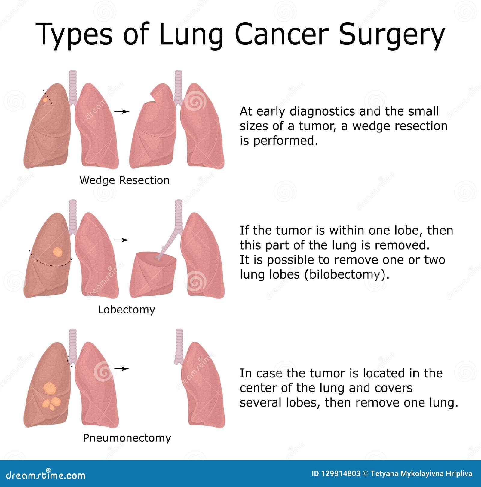 Illustration Des Types De Cancer De Poumon Illustration de Vecteur ...