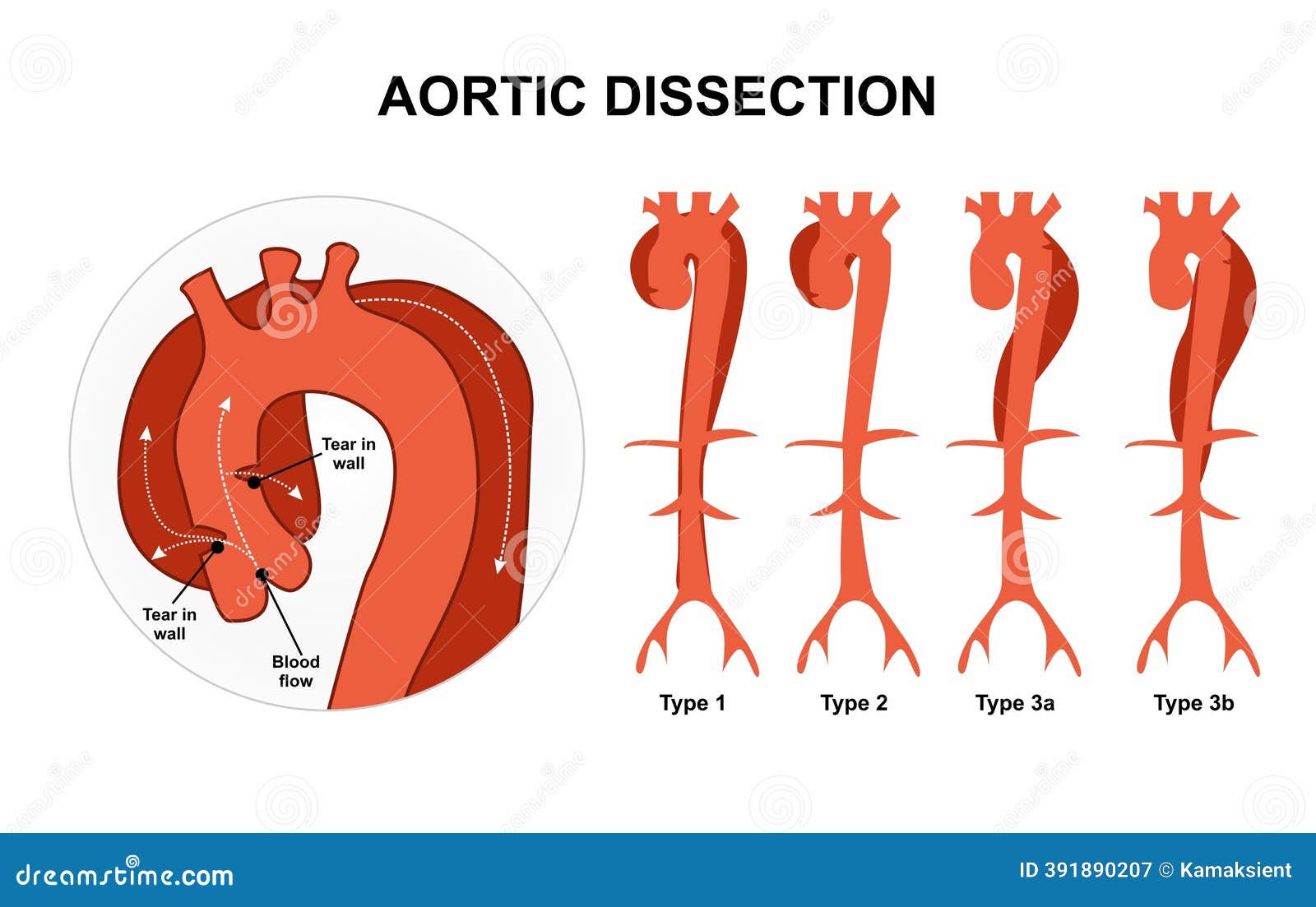 Aortic Dissection. Longitudinal And Cross-section Of Blood Vessel. Cartoon Vector ...