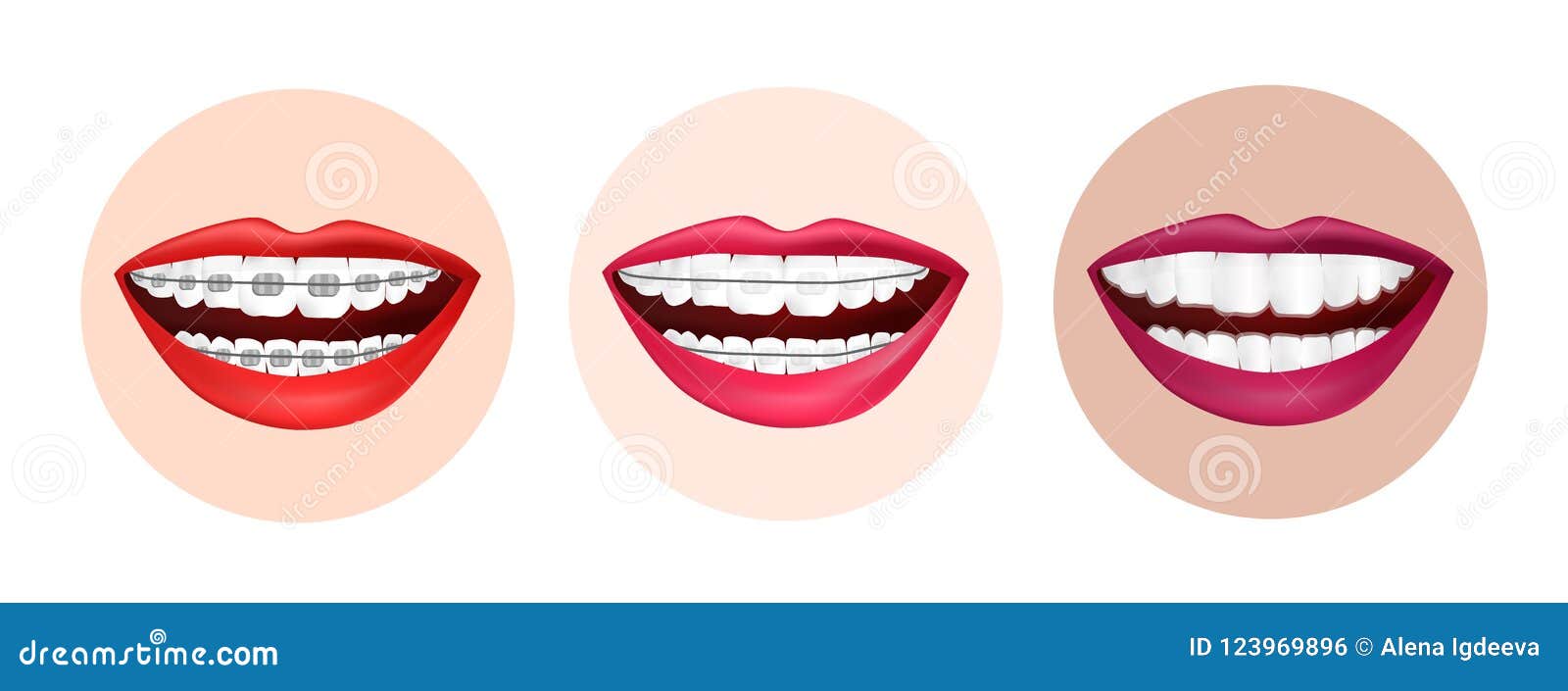 Infographic braces stock vector. Illustration of pure - 123969896