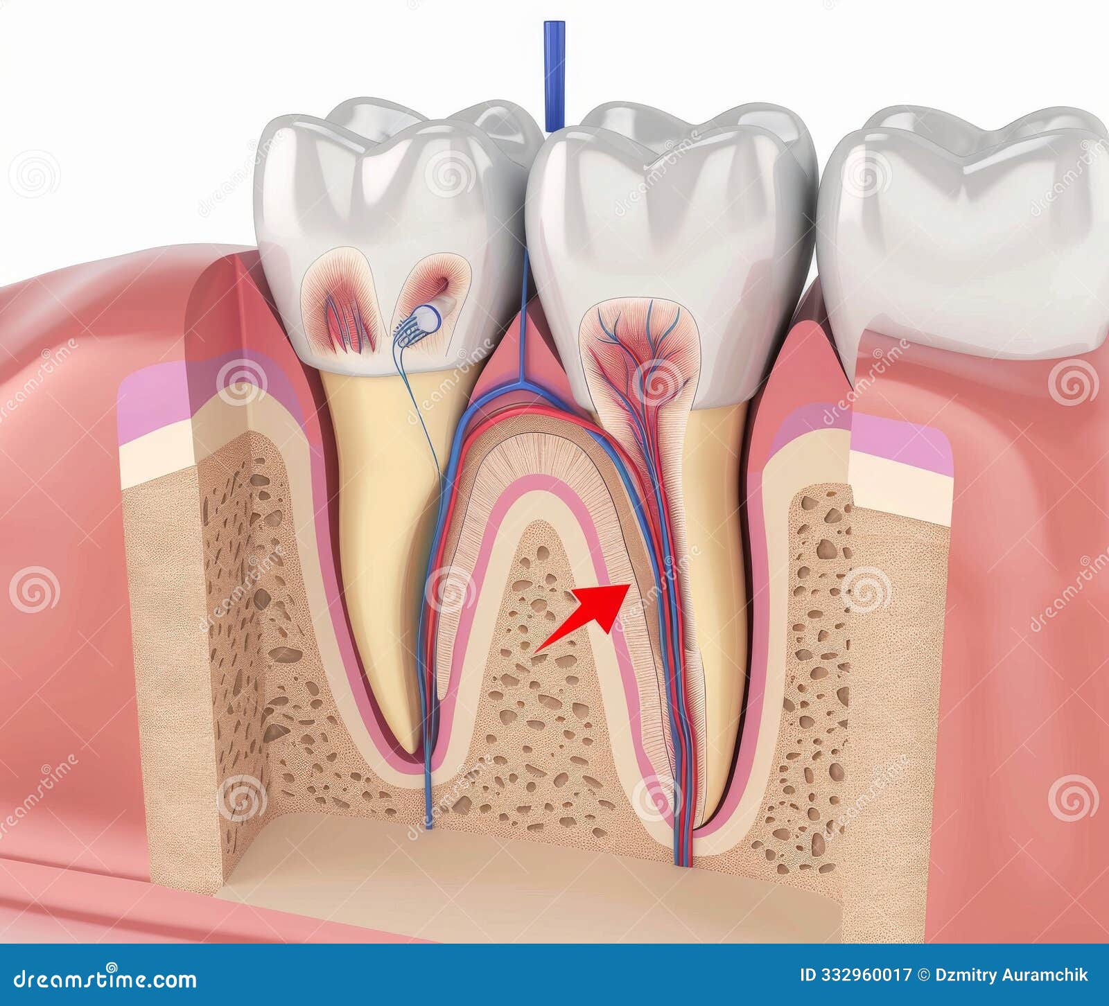 An Illustration of the Endodontic Root Canal Treatment Process in 3D ...