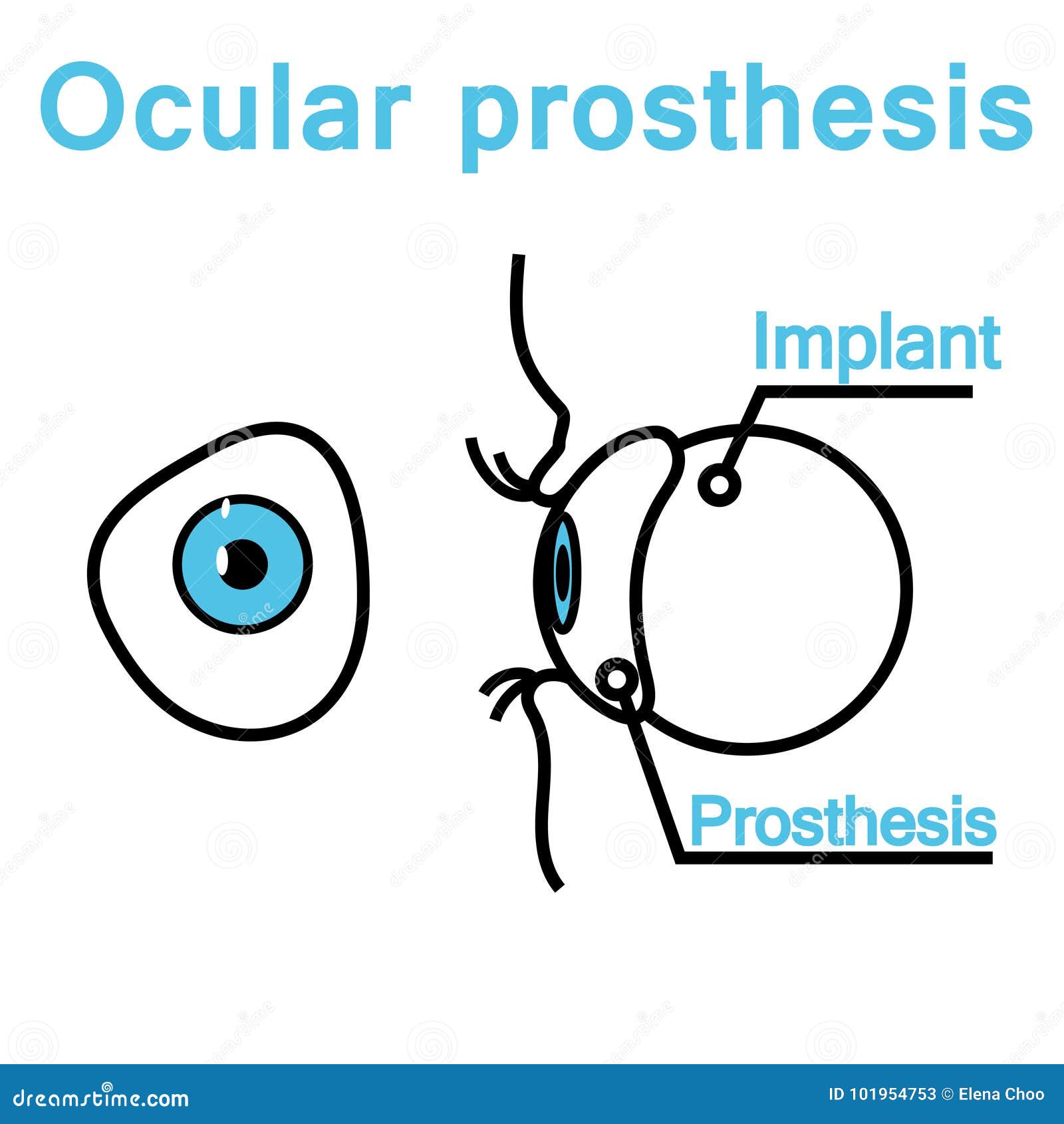 Illustration of an Eye Prosthesis Stock Vector - Illustration of ...