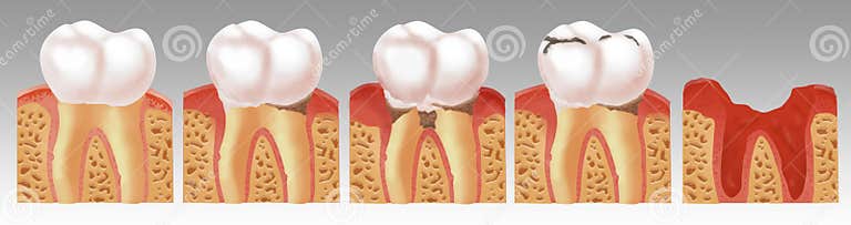 Illustration of the Process of Tooth Decay Stock Illustration ...