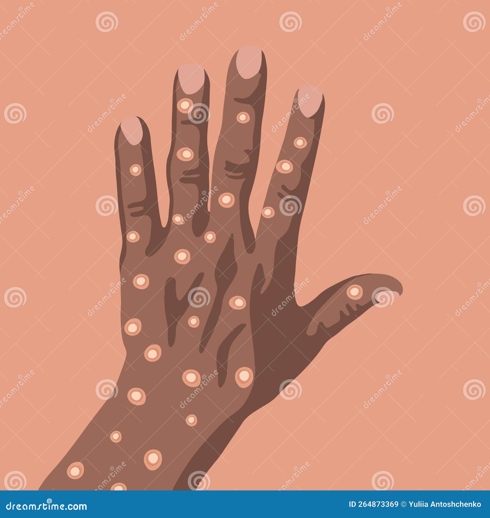 Illustration of a Hand of a Black Man with Monkey Pox. Stock Vector ...
