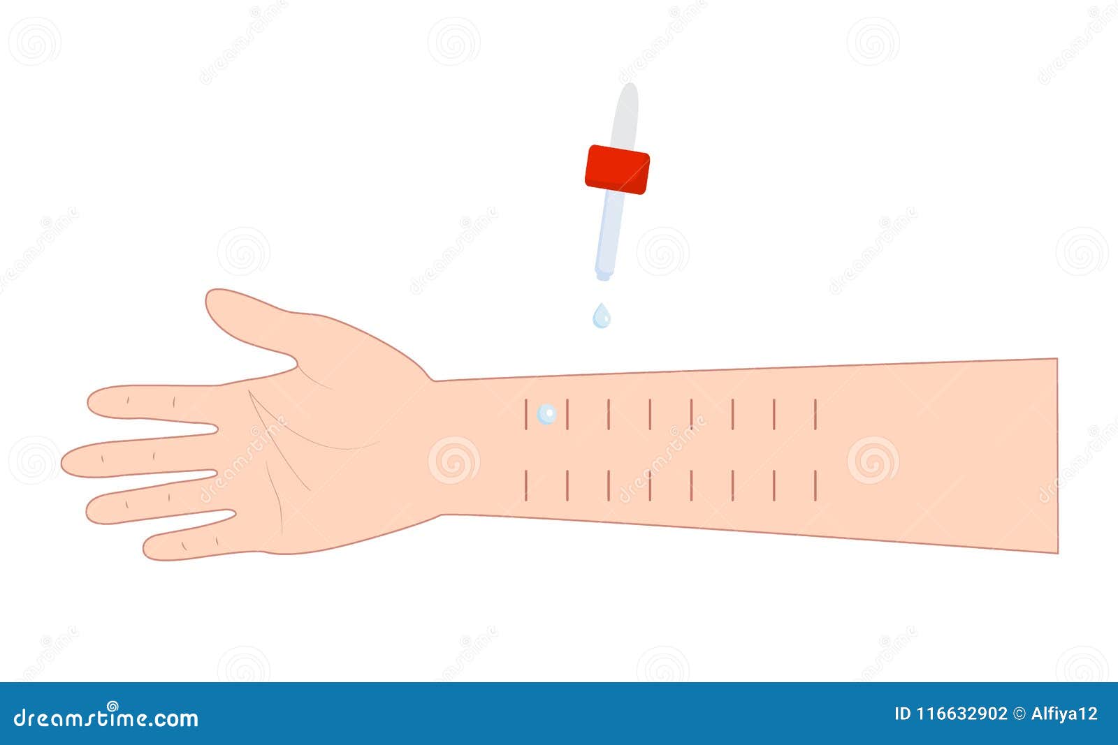 Illustration of a Hand with Skin Tests for Allergy Stock Vector ...