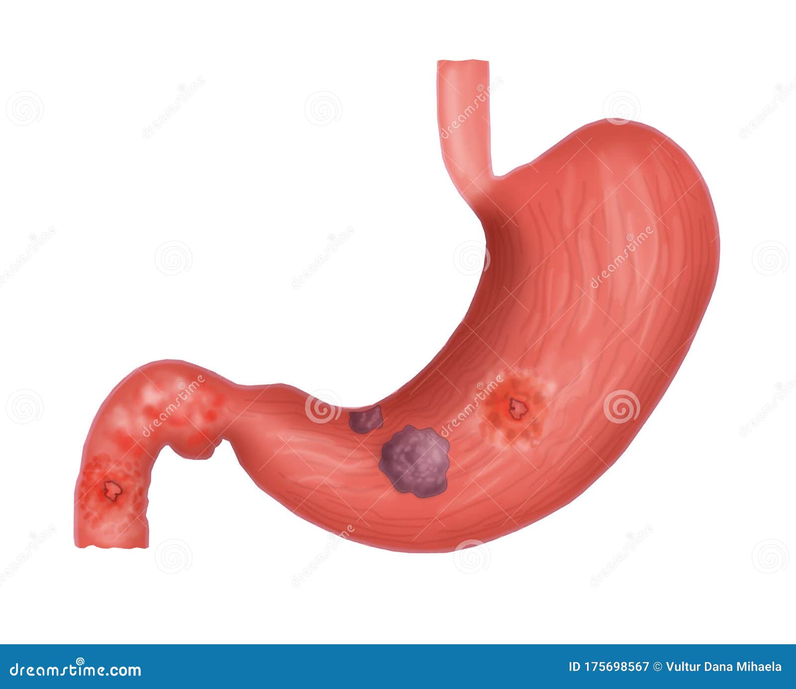Duodenal Cancer Helicobacter Royalty-Free Stock Photo | CartoonDealer ...