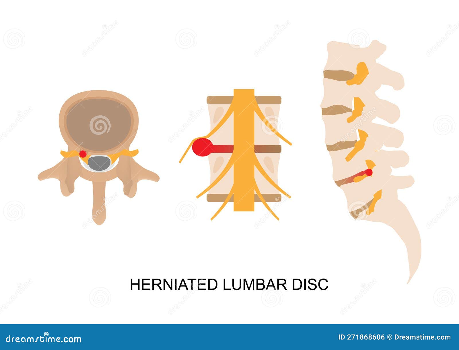 Illustration of Herniated Lumbar Disc in Different View Stock Vector ...