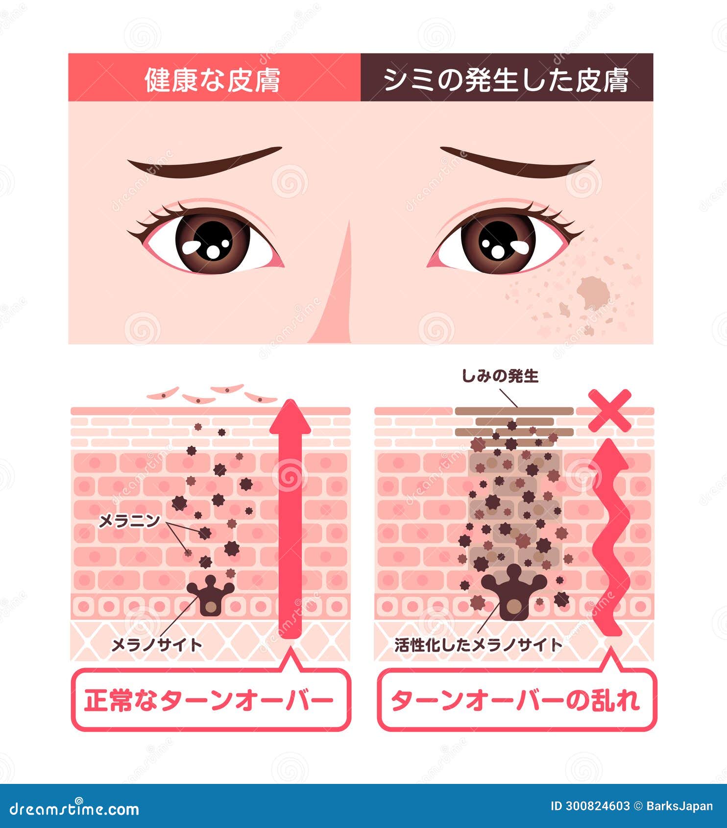 Illustration of How Skin Spots (hyperpigmentation) are Created Stock ...