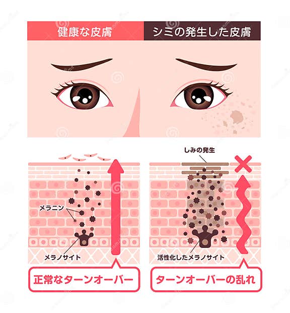 Illustration of How Skin Spots (hyperpigmentation) are Created Stock ...