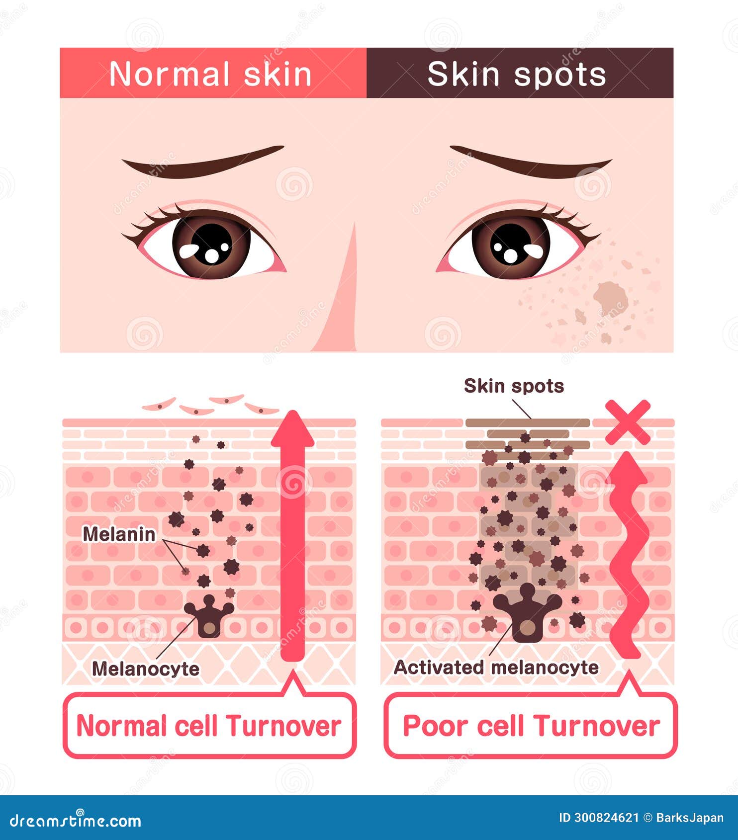 Illustration Of How Skin Spots (hyperpigmentation) Are Created Cartoon ...