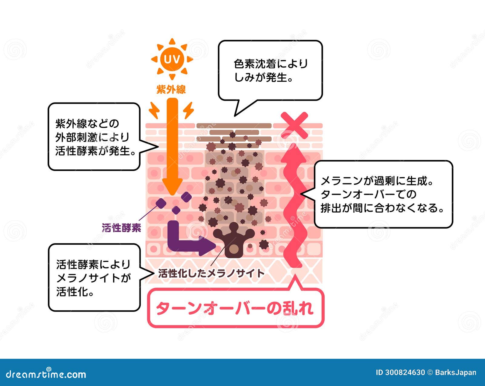 Illustration of How Skin Spots (hyperpigmentation) are Created Stock ...