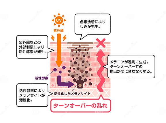 Illustration of How Skin Spots (hyperpigmentation) are Created Stock ...