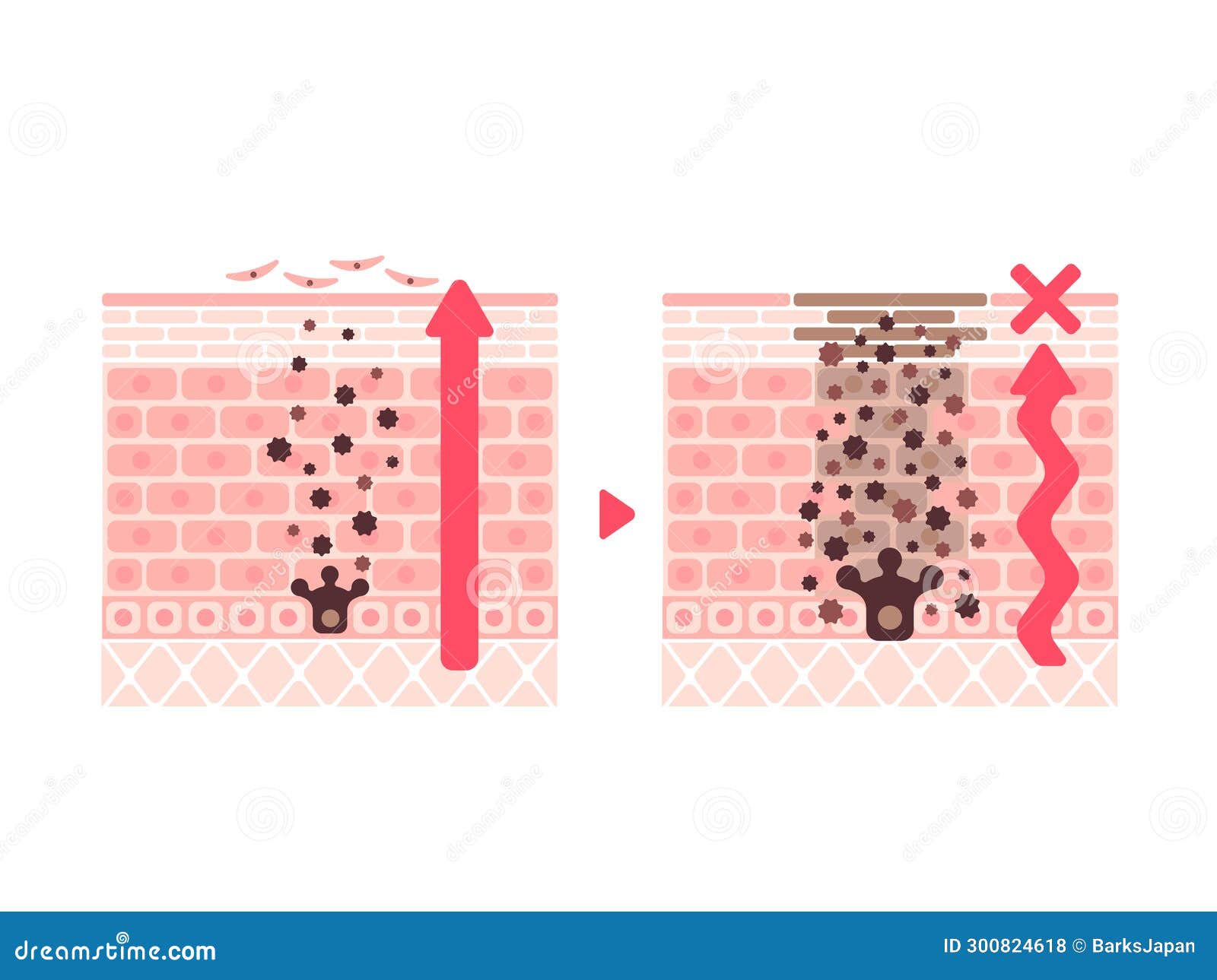 Illustration of How Skin Spots (hyperpigmentation) are Created Stock ...