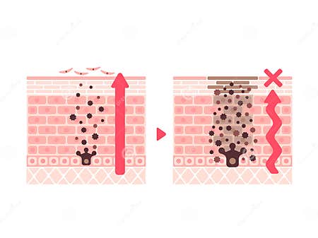 Illustration of How Skin Spots (hyperpigmentation) are Created Stock ...