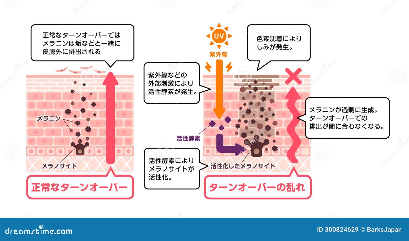 Illustration of How Skin Spots (hyperpigmentation) are Created Stock ...