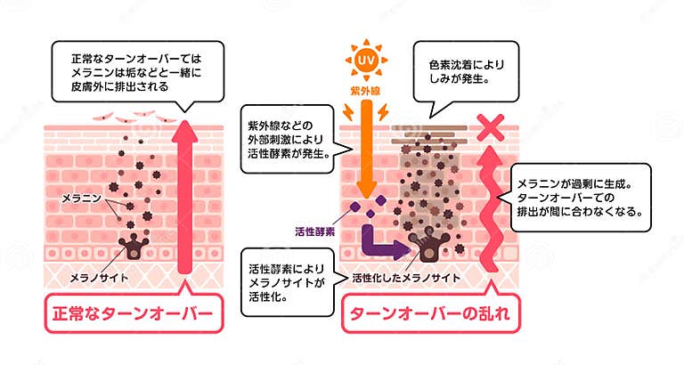 Illustration of How Skin Spots (hyperpigmentation) are Created Stock ...