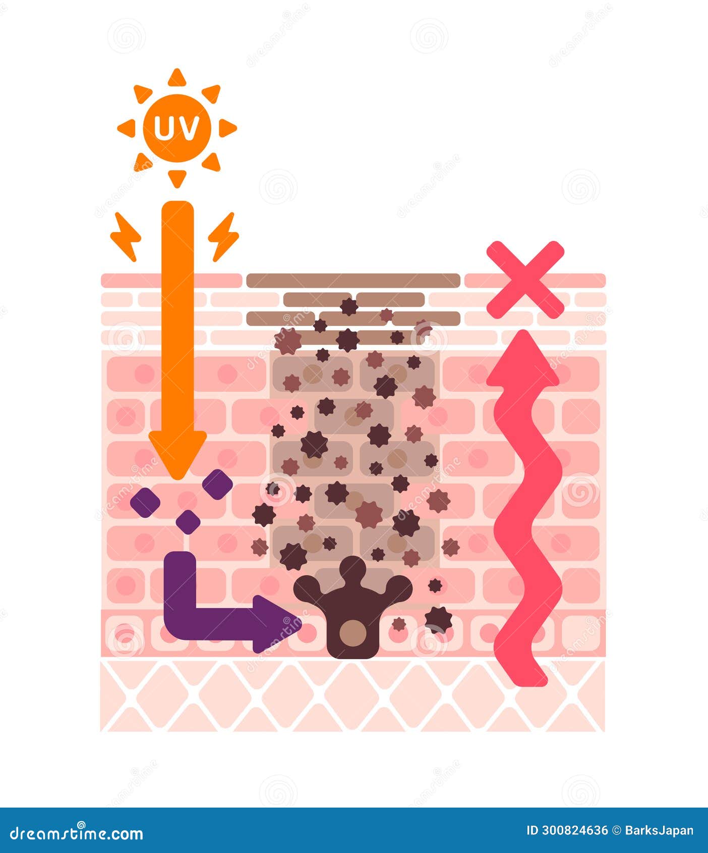 Illustration of How Skin Spots (hyperpigmentation) are Created Stock ...