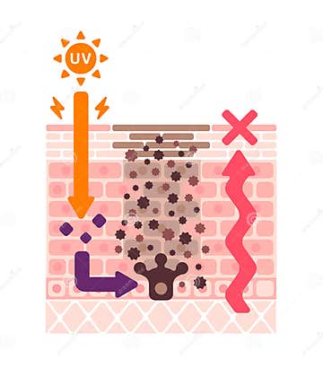 Illustration of How Skin Spots (hyperpigmentation) are Created Stock ...