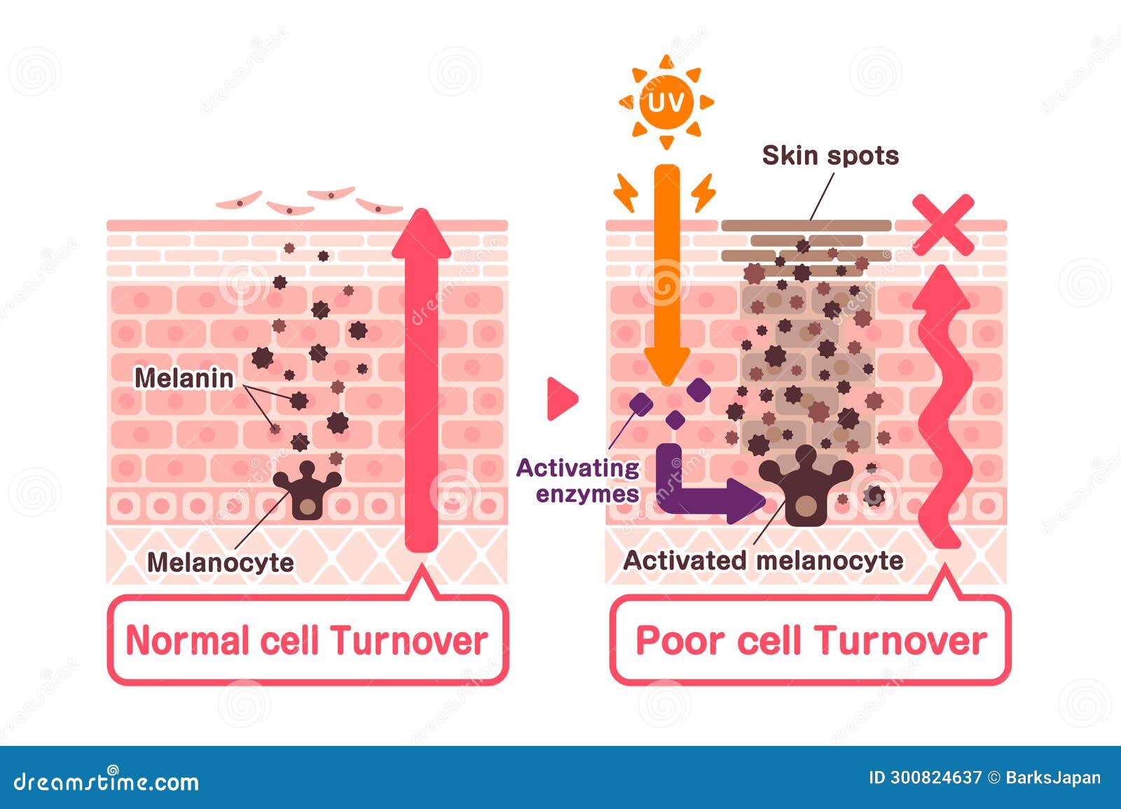 Illustration of How Skin Spots (hyperpigmentation) are Created Stock ...